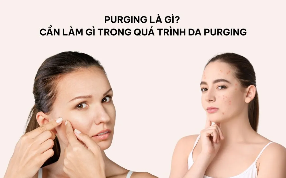 Purging Là Gì? Cần Làm Gì Trong Quá Trình Da Purging